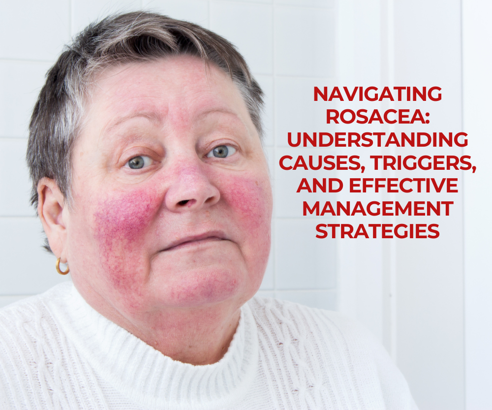 Navigating Rosacea: Understanding Causes, Triggers, and Effective ...
